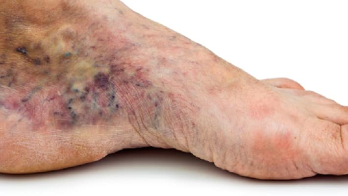 கால்களை கடுமையாக பாதிக்கும் சர்க்கரை நோய் !! பாதுகாப்பது எப்படி