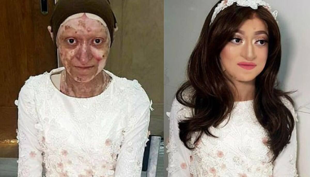 ശരീരം മുഴുവന്‍ പഴുപ്പ് നിറഞ്ഞ കുമിളകള്‍; അറിയണം ഈ അപൂര്‍വ്വരോഗത്തെ ...