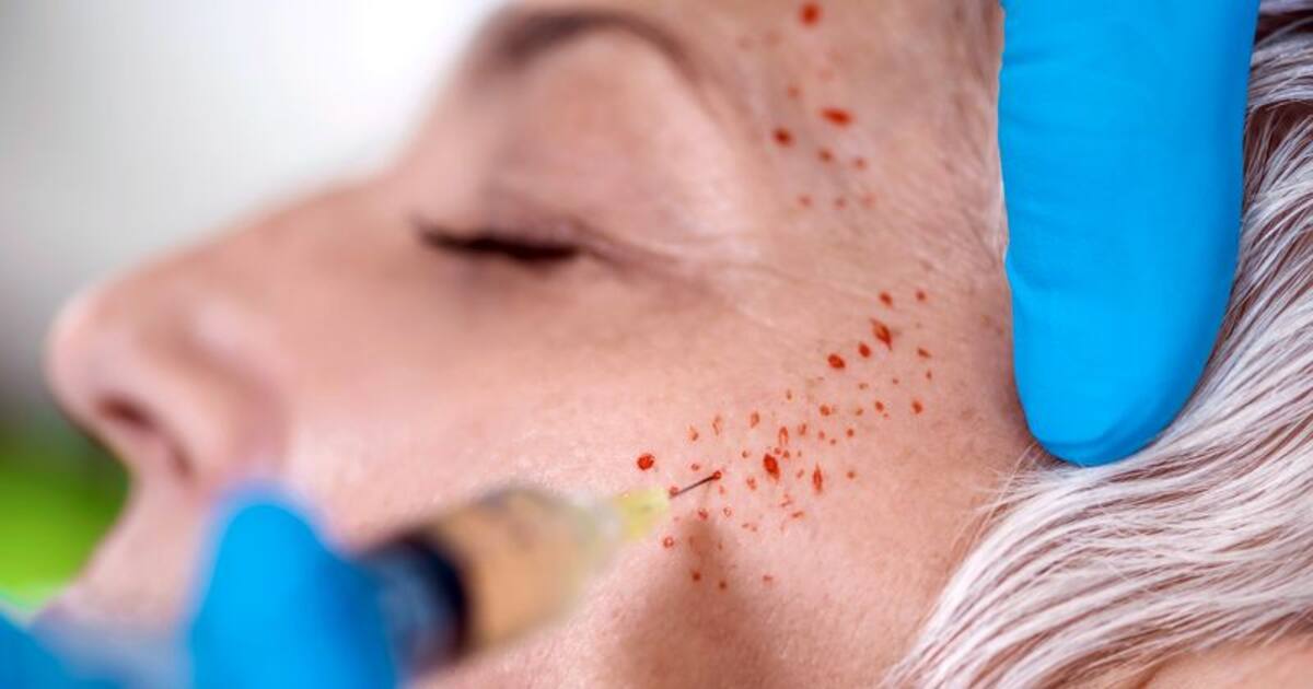 Vampire facial: అందం కోసం ఆరాట పడితే.. ప్రమాదంలో పడ్డ ప్రాణాలు.. అసలేం ...