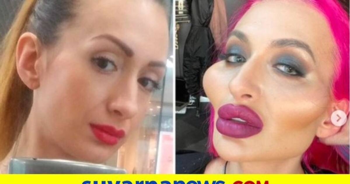 ವಿಶ್ವದಲ್ಲೇ ದೊಡ್ಡ ಕೆನ್ನೆಯ ಈ ಮಾಡೆಲ್‌ ಸರ್ಜರಿ ಮೊದಲು ಹೀಗಿದ್ಲು! | Insta model ...