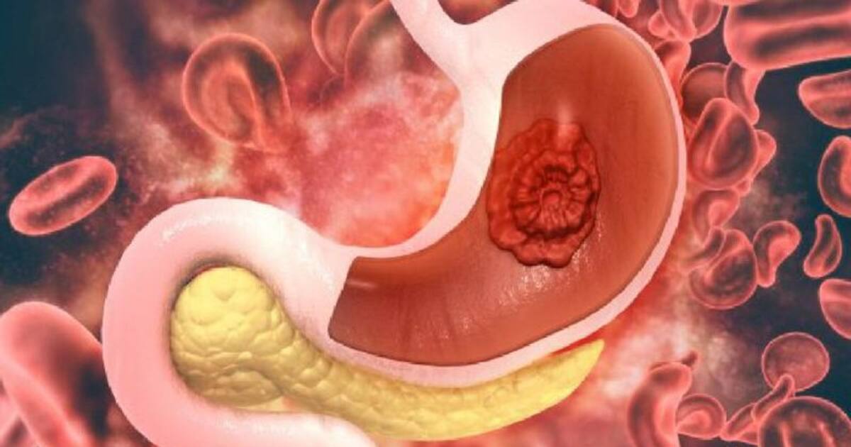 Stomach Cancer Awareness: Learn about risks, treatments, and prevention