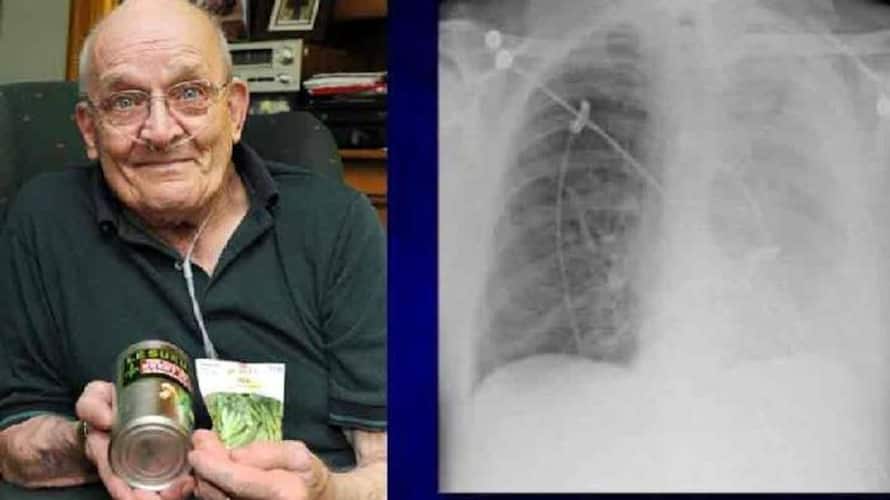 Pea plant in lung : മനുഷ്യന്റെ ശരീരത്തിൽ ചെടി വളരുമോ? 75 -കാരന്റെ ...