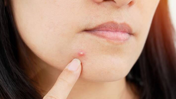 Menstrual Acne menstrual-acne