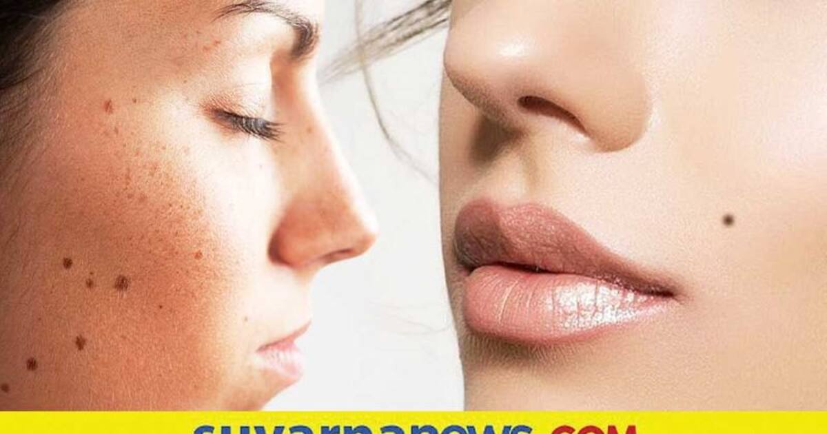 Skin and Fleck: ಬ್ಯೂಟಿ ಸ್ಪಾಟ್ ಆಯ್ತು ಕ್ಯಾನ್ಸರ್ ಸೂಚಕ | Small fleck in ...
