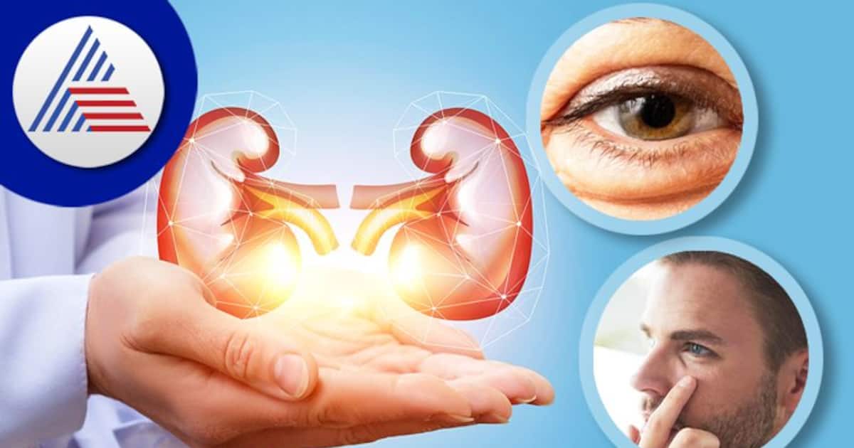 ಕಣ್ಣು, ಚರ್ಮದಲ್ಲಿ ಈ ಲಕ್ಷಣವಿದ್ದರೆ, ಇರಬಹುದು ಕಿಡ್ನಿ ಸಮಸ್ಯೆ!