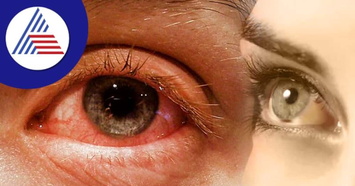 ಎಲ್ಲೆಡೆ ಹರಡುತ್ತಿರುವ ಮದ್ರಾಸ್ ಐ, ಹುಷಾರಾಗಿದ್ದು ಆರೋಗ್ಯ ಕಾಪಾಡಿಕೊಳ್ಳಿ