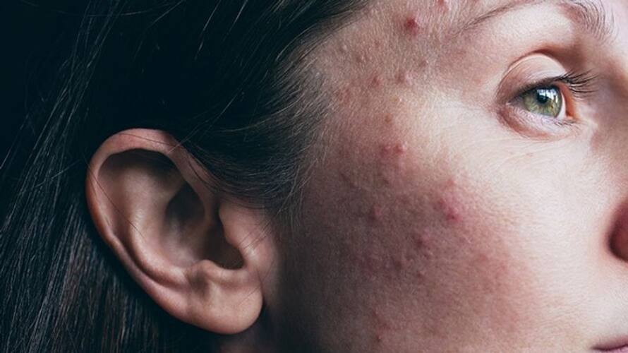 Google Lens will help you in detecting rashes, skin conditions and more ...