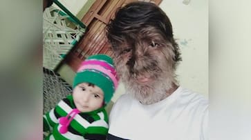 MP boy diagnosed with rare 'werewolf syndrome'; Know about the disease ...