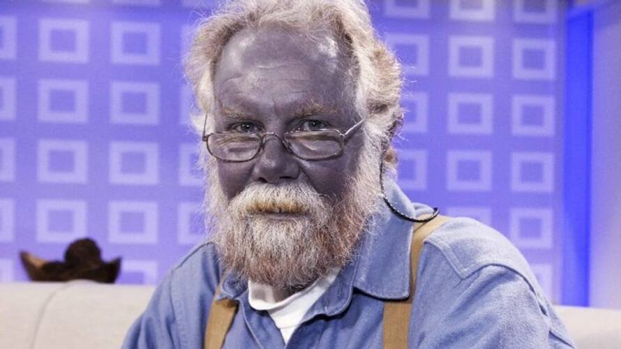 Blue Skin Man : ஊட்டச்சத்து கிடைக்க வேண்டிய ஆசைப்பட்டு முதியவருக்கு ...