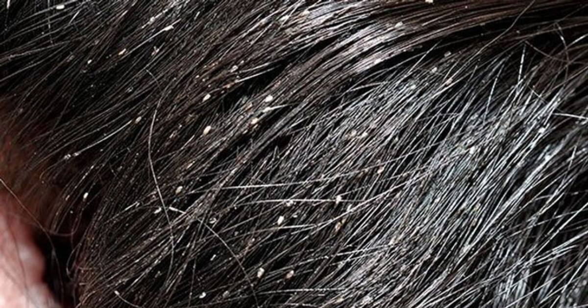 പേൻ ശല്യം നിങ്ങളെ അലട്ടുന്നുണ്ടോ? പരിഹാരം വീട്ടിൽ തന്നെയുണ്ട്