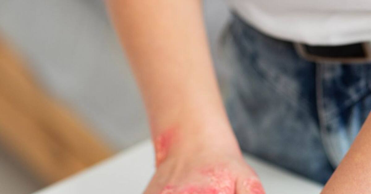 Here are 10 ways to avoid skin rashes during monsoon