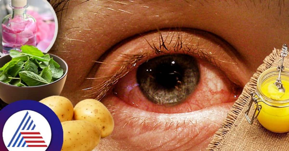 ಕಣ್ಣಿನ ಸೋಂಕಿಗೆ ಮನೆ ಮದ್ದು: ಅನಾರೋಗ್ಯಕ್ಕೆ ಹೇಳಿ ಗುಡ್ ಬೈ