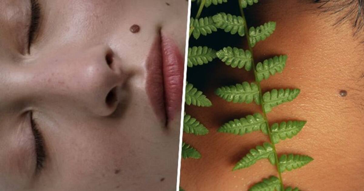 Unusual moles on your body? Here are 6 things which demands attention