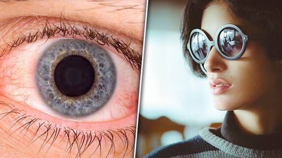 Conjunctivitis alert: 'Kala Chasma' no remedy to prevent spread ...