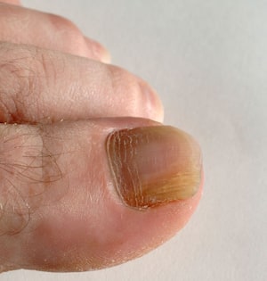 7 ways how your Nails can indicate underlying health issues