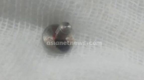 Kerala: Surgical clip left in teenager's stomach after surgery; Family ...