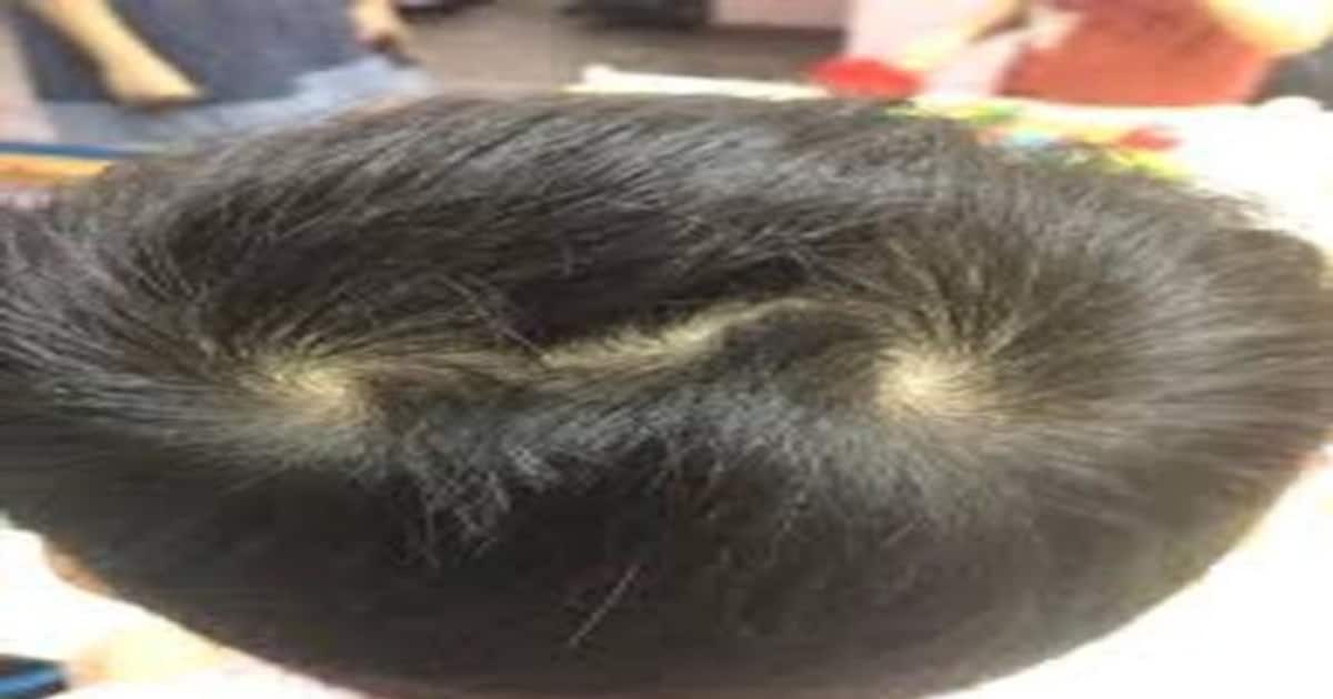 myths and scientific reasons behind double whorl in head