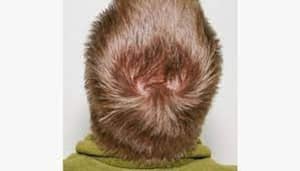 myths and scientific reasons behind double whorl in head