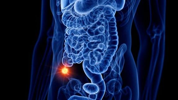What is appendix cancer? Know the common symptoms and recognise the ...
