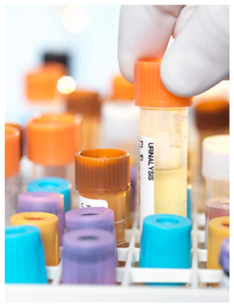 ശരീരത്തിൽ യൂറിക് ആസിഡ് കൂട്ടുന്ന 7 ഭക്ഷണങ്ങൾ