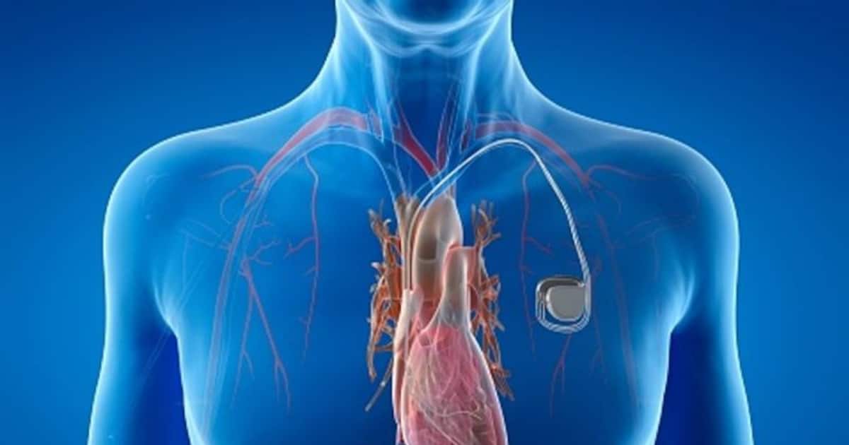 Breakthrough surgery: In a first, 'smallest' pacemaker successfully ...