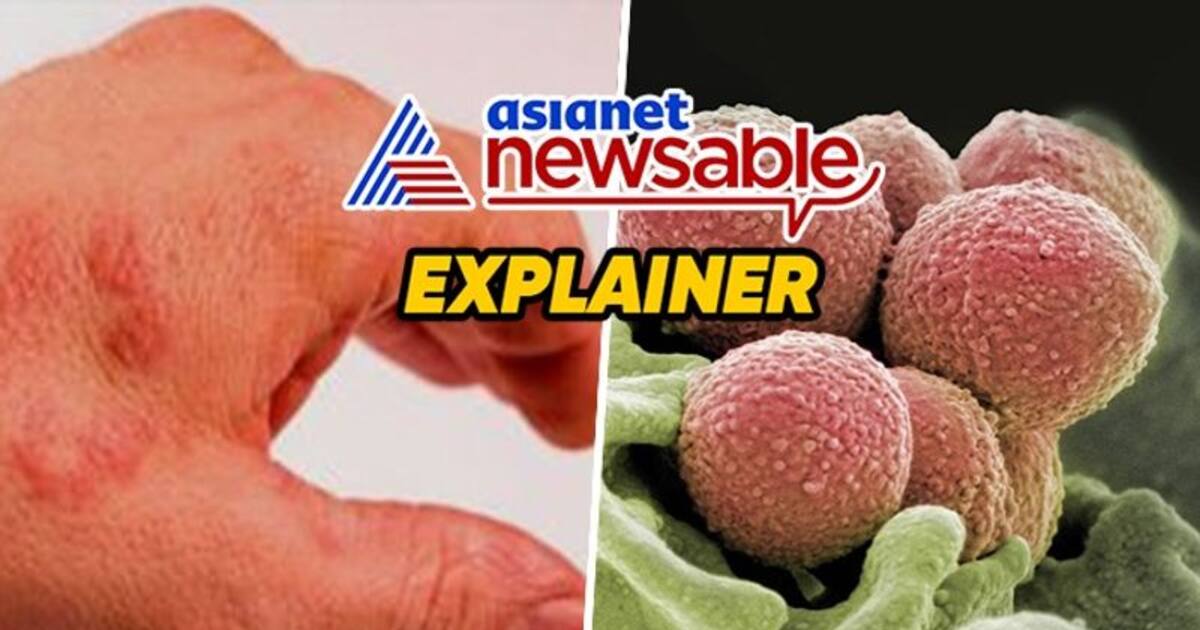 Explained: What is STSS, deadly 'flesh-eating bacteria' spreading in ...
