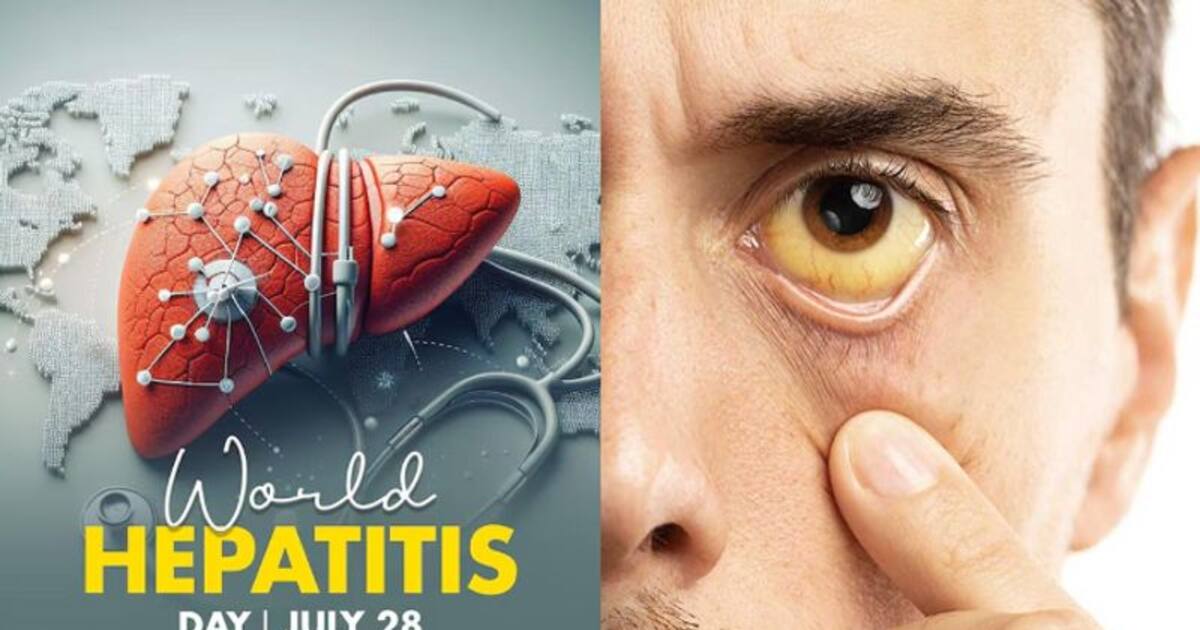 Hepatitis: What type of liver infection is this? Types, symptoms ...